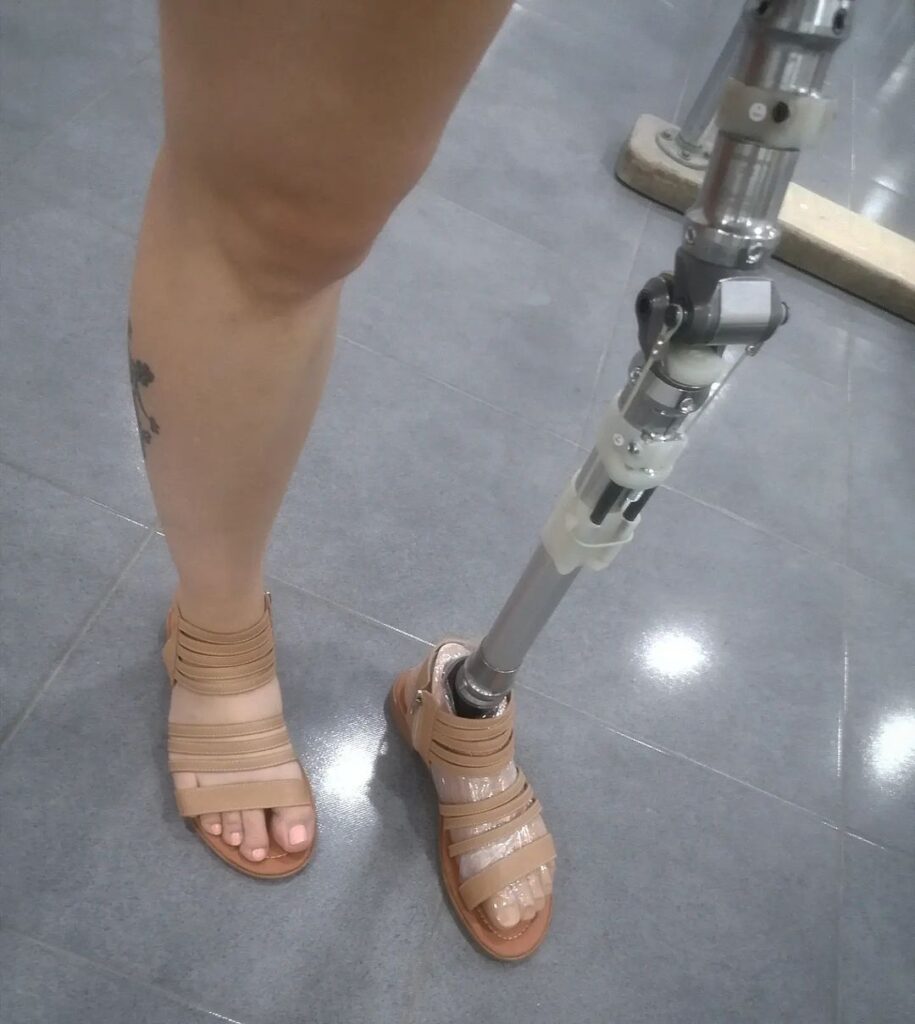 Prosthetic leg or leg fitting in Iran | Best Surgeons & Hospitals