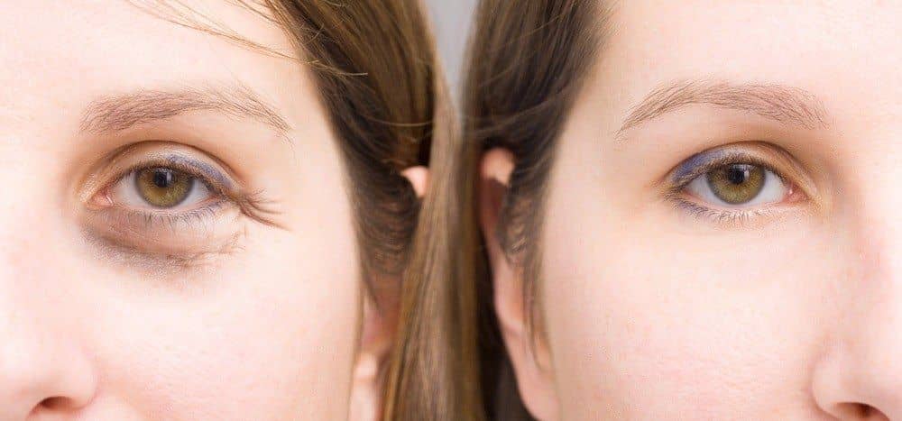 Types of eye plastic surgery in Iran, Shiraz | The best doctor