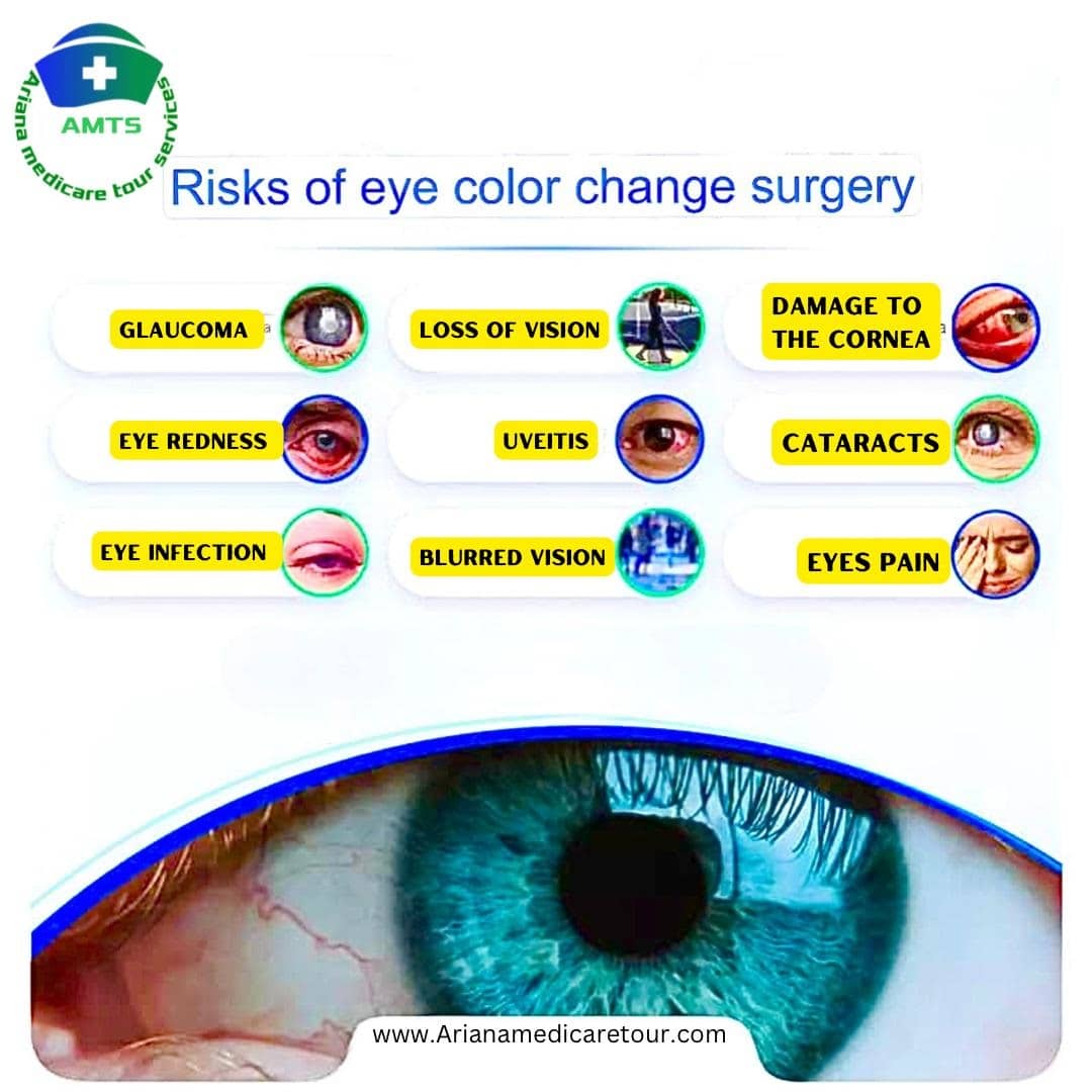 Types of eye plastic surgery in Iran, Shiraz | The best doctor